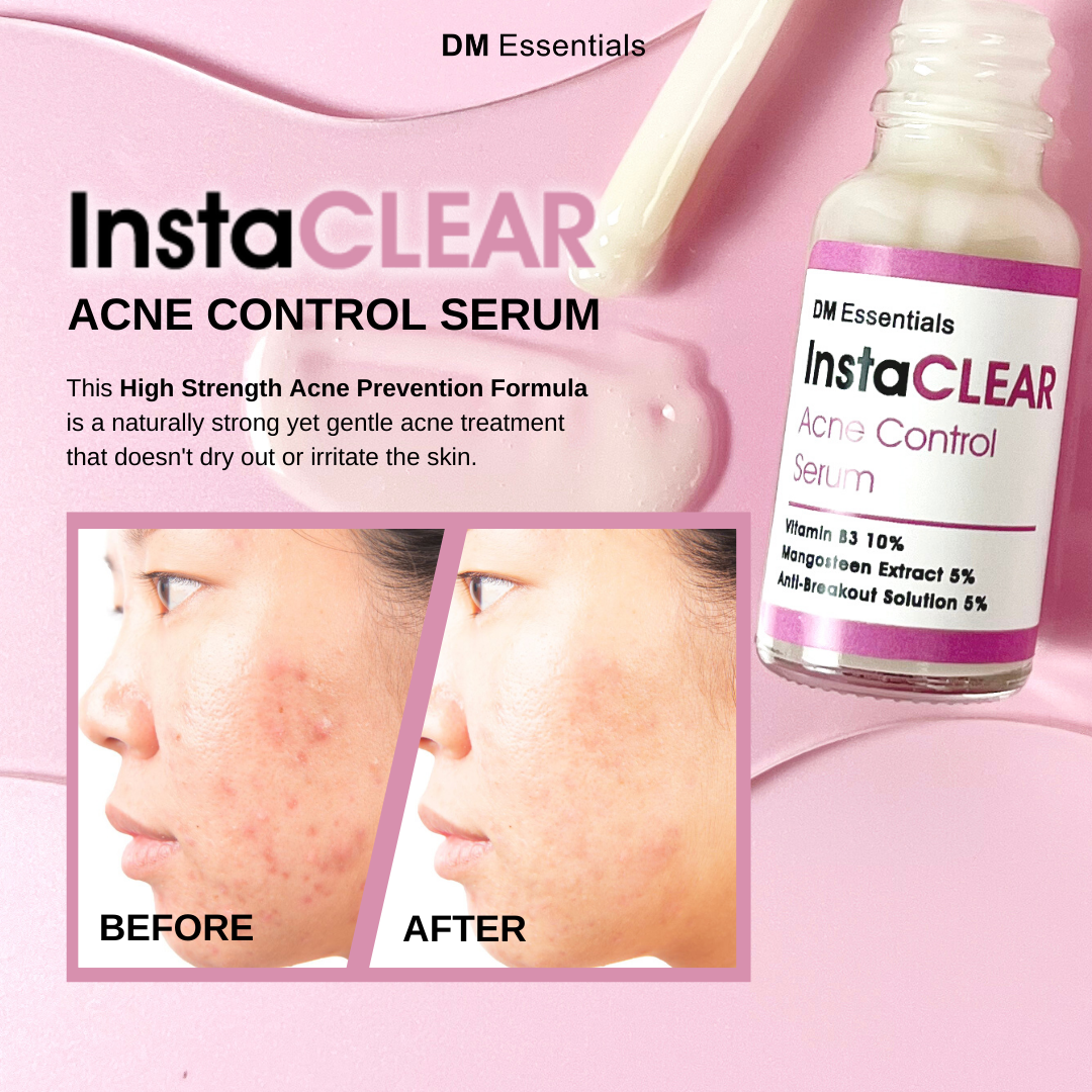 InstaCLEAR ACNE CONTROL SERUM (20ML) | dmessentials